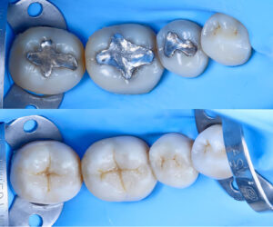 Reemplazo de amalgamas dentales por resina ¿Por qué debo hacerlo? - Dr ...